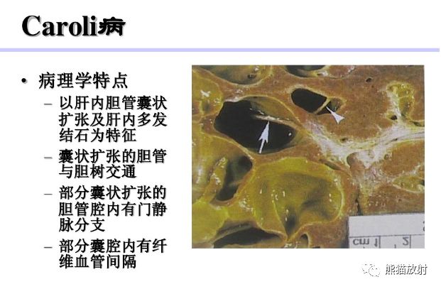Caroli病MRI表现及病理特征 – 影像PPT