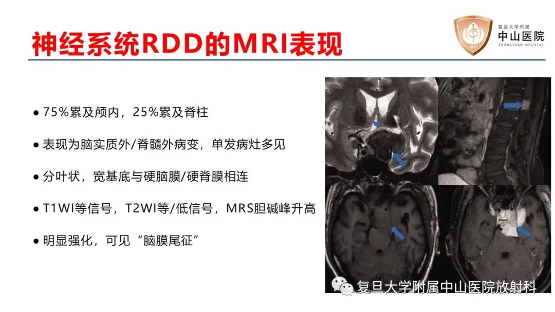 【病例】颅内窦组织增生伴巨大淋巴结病/罗道病(RDD)一例CT及MR – 影像PPT