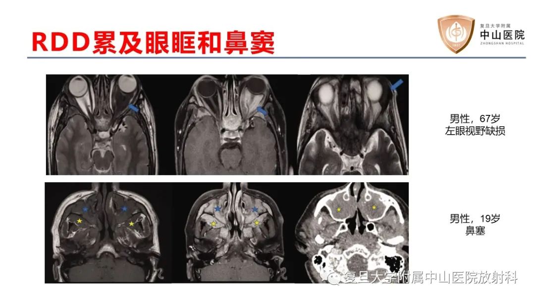 【病例】颅内窦组织增生伴巨大淋巴结病/罗道病(RDD)一例CT及MR – 影像PPT