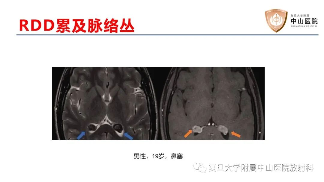 【病例】颅内窦组织增生伴巨大淋巴结病/罗道病(RDD)一例CT及MR – 影像PPT