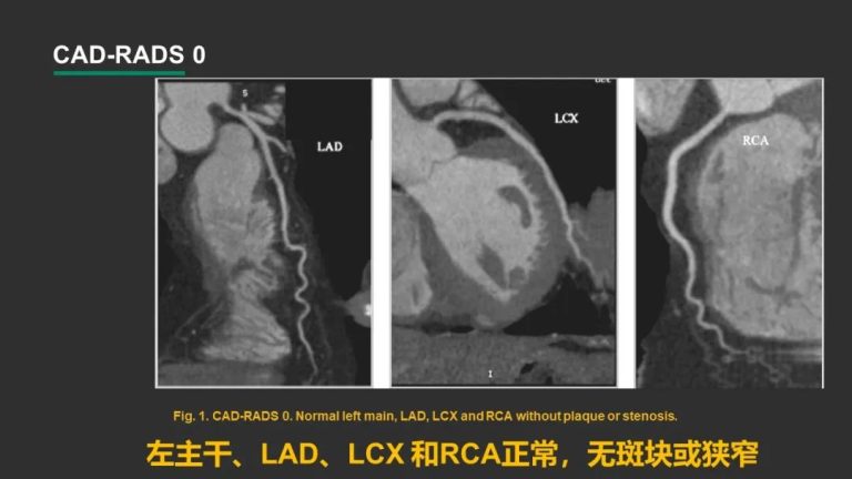 【PPT】冠脉CAD-RADS分级系统解读 – 影像PPT